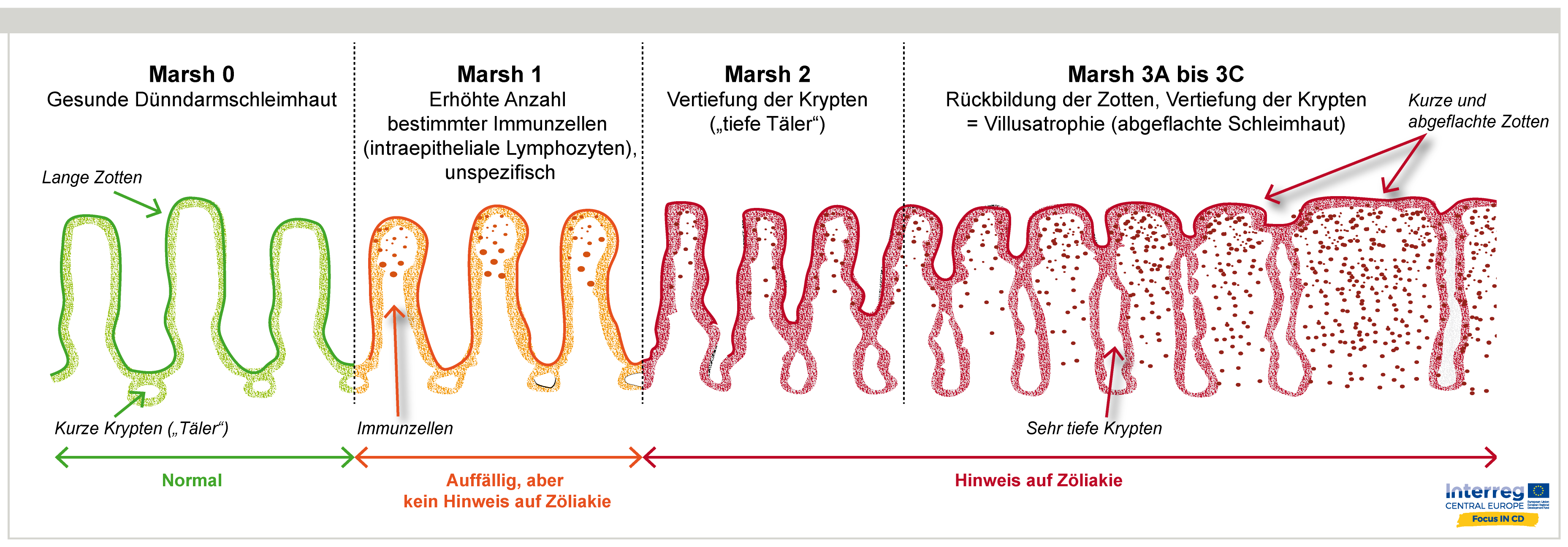 Zöliakie verstehen DP: Thema 1 - Wie testet der Arzt auf Zöliakie?: 1.2 ...