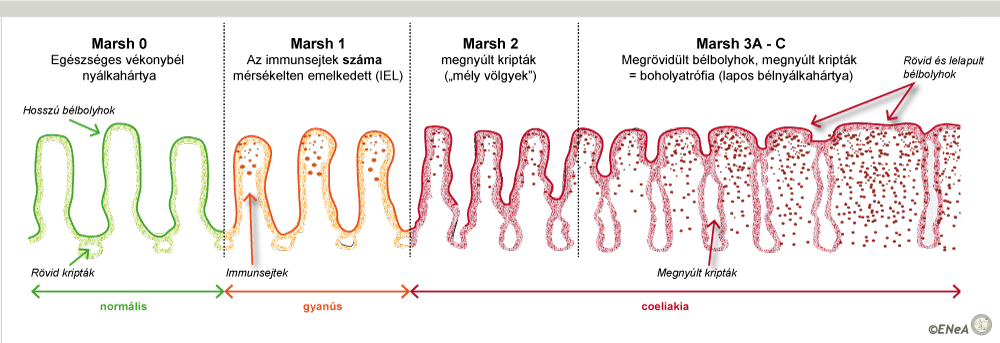 Szakembereknek: 3. Lecke: A coeliakia diagnózisa: 3.2 Vékonybél ...